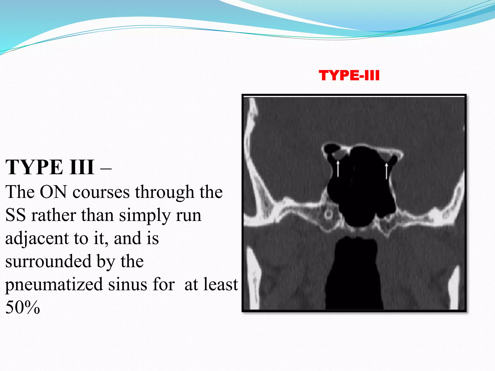 Sphenoid sinus and optic nerve | PPTX