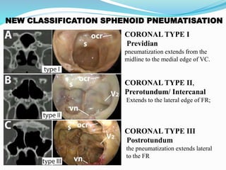 Sphenoid sinus and optic nerve | PPTX