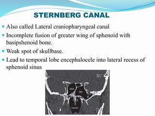Sphenoid sinus and optic nerve | PPTX