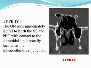 Sphenoid sinus and optic nerve | PPTX