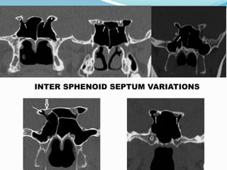 Sphenoid sinus and optic nerve | PPTX