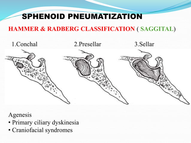 Sphenoid sinus and optic nerve