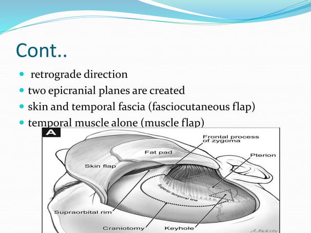 Sphenoid wing meningioma | PPTX | Brain and Nervous System Disorders ...