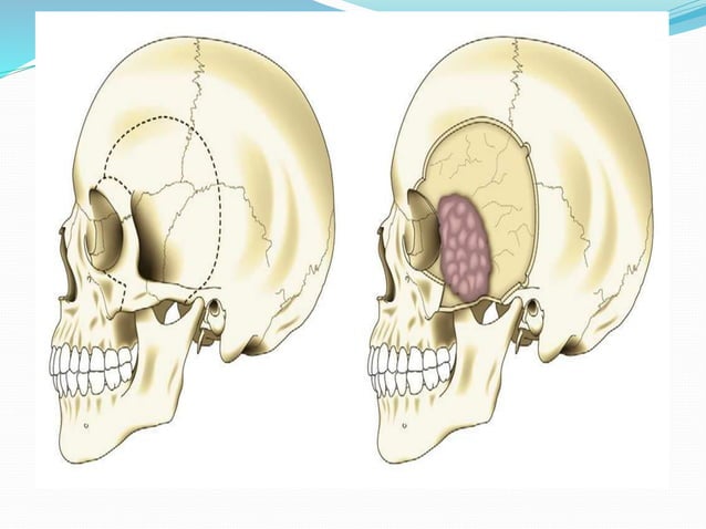 Sphenoid wing meningioma | PPTX | Brain and Nervous System Disorders ...