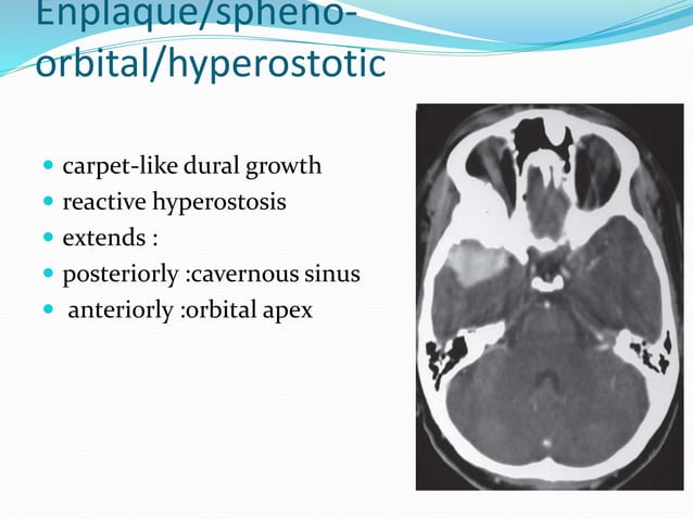 Sphenoid wing meningioma | PPTX | Brain and Nervous System Disorders ...