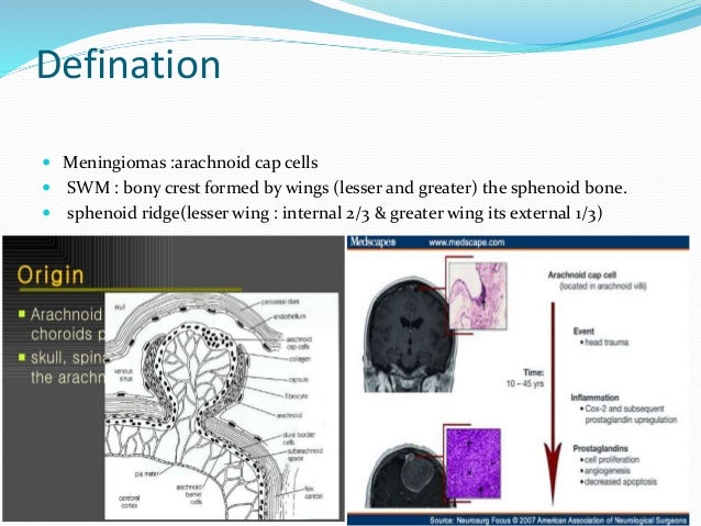 Sphenoid wing meningioma