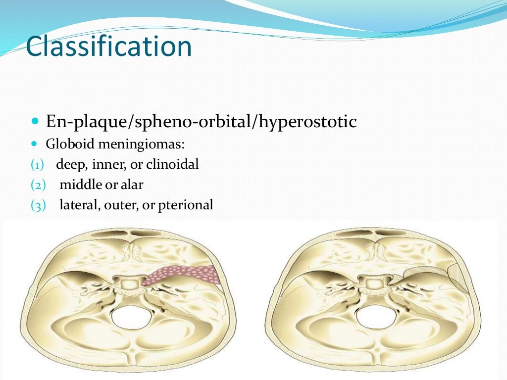 Sphenoid wing meningioma
