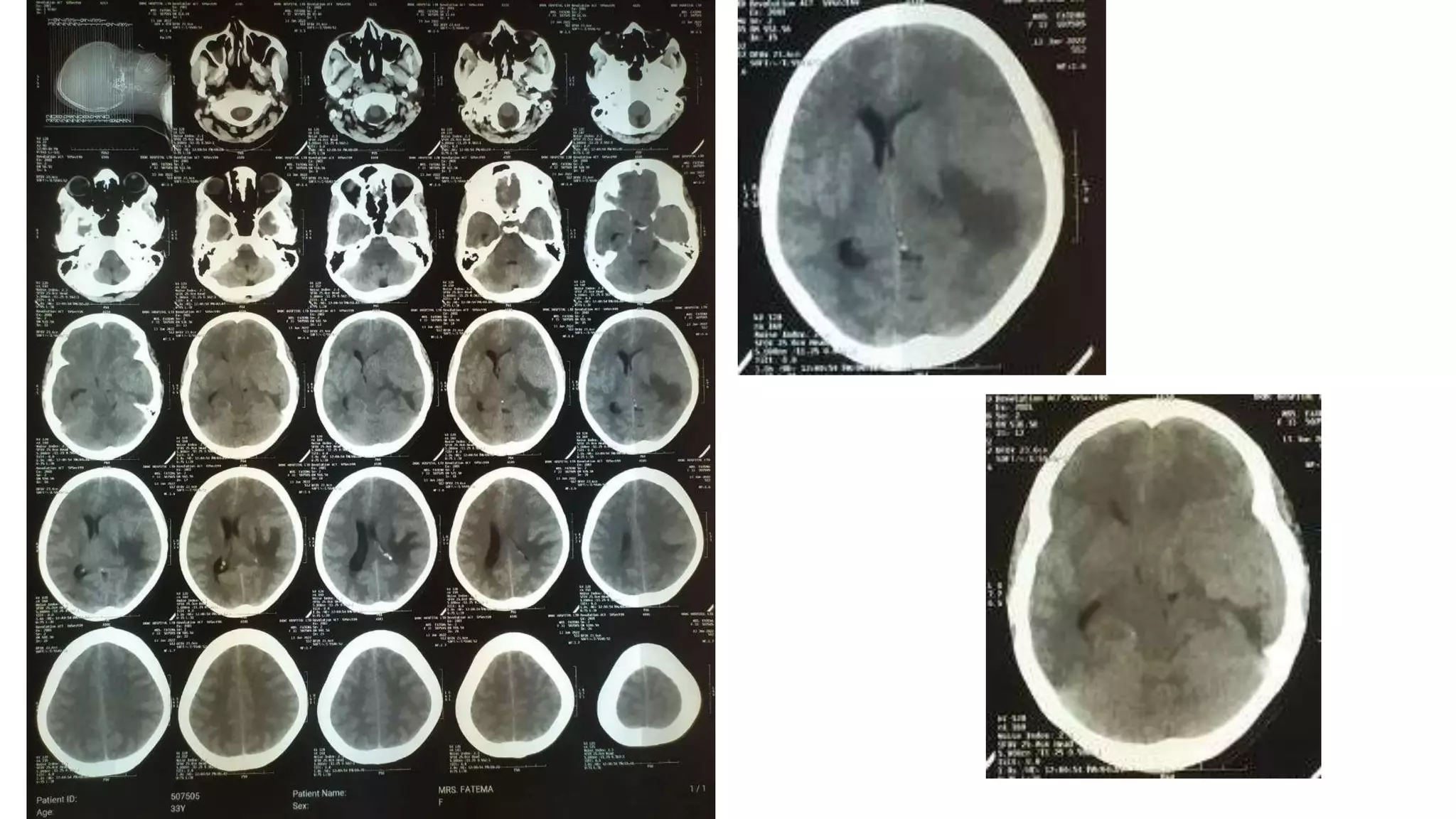 Sphenoid wing meningioma Fatema.pptx | Brain and Nervous System ...