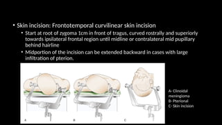 Sphenoid Wing, Sphenoorbital, Clinoidal,.pptx