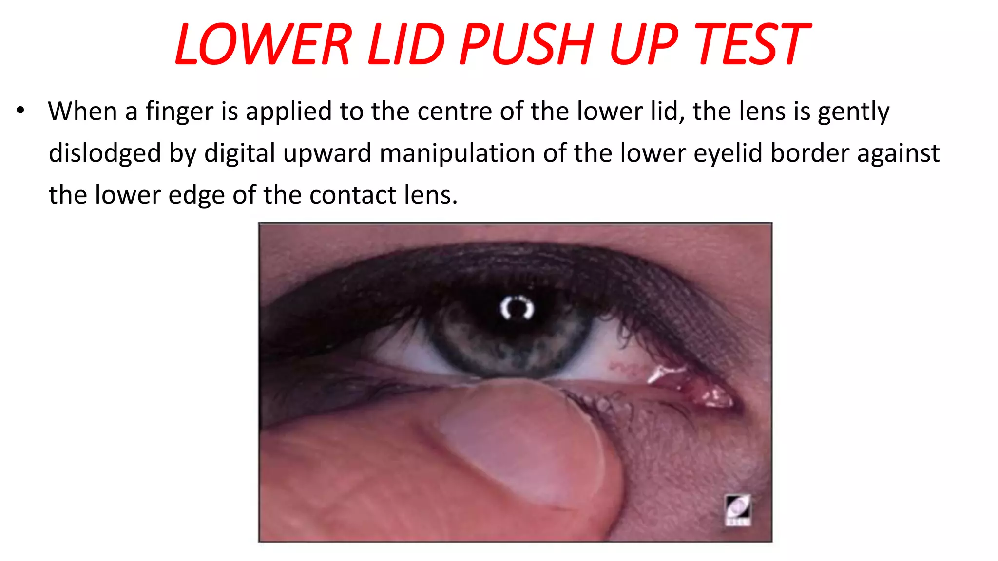 Spherical soft contact lens fitting | PPTX