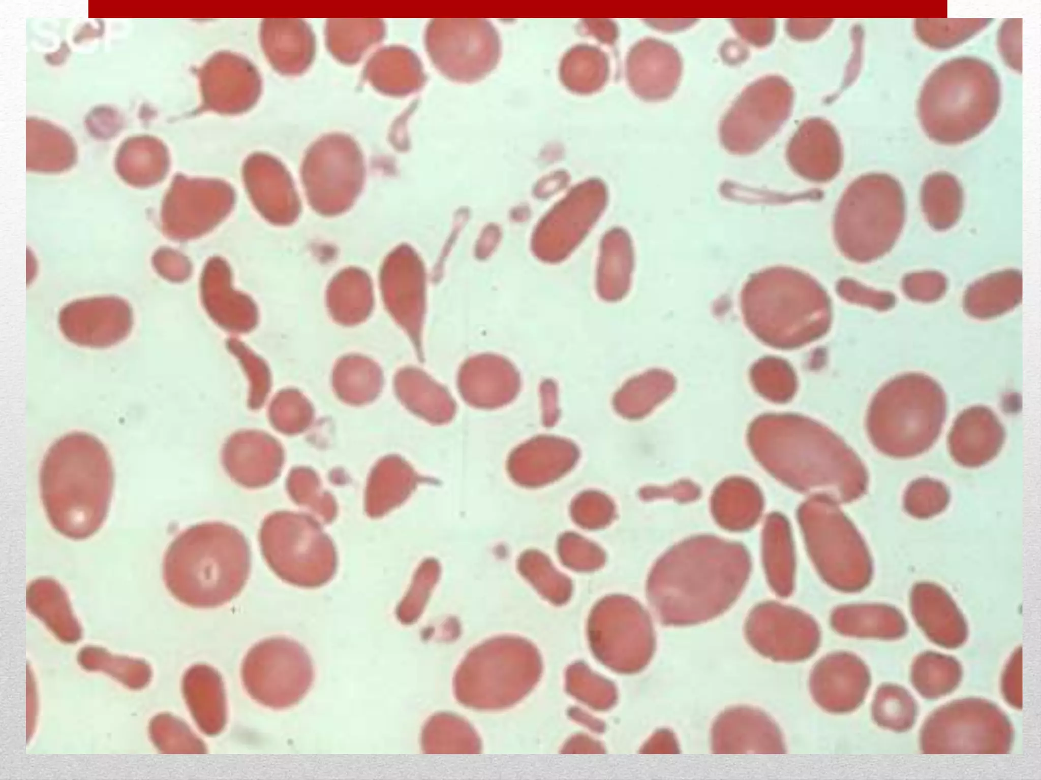 Spherocytes significance and differential diagnosis | PPTX
