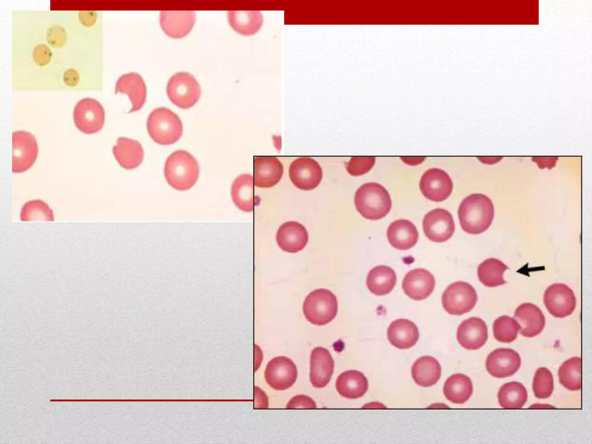 Spherocytes significance and differential diagnosis | PPTX