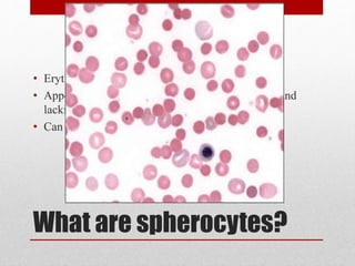 Spherocytes significance and differential diagnosis | PPTX