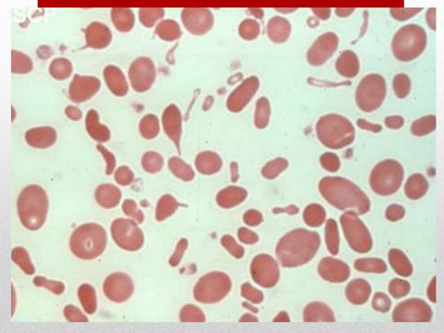 Spherocytes significance and differential diagnosis | PPTX | Blood ...