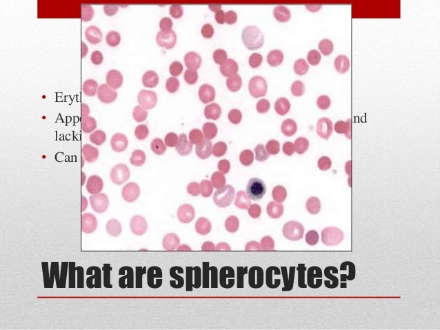 Spherocytes significance and differential diagnosis