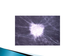 Spiculate breast mass | PPTX