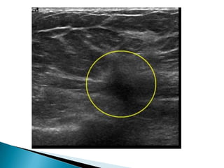 Spiculate breast mass | PPTX