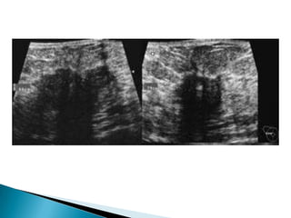 Spiculate breast mass | PPTX