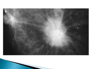 Spiculate breast mass | PPTX