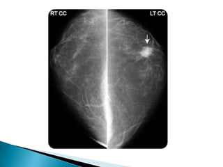 Spiculate breast mass | PPTX