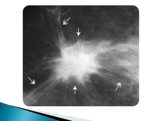 Spiculate breast mass | PPTX