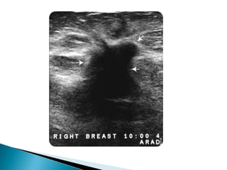 Spiculate breast mass | PPTX