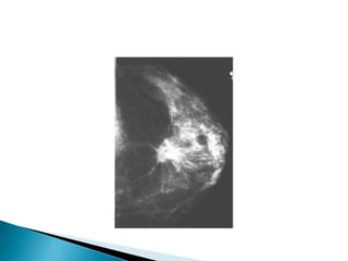 Spiculate breast mass | PPTX