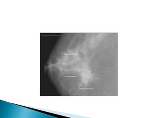 Spiculate breast mass | PPTX