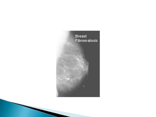 Spiculate breast mass | PPTX