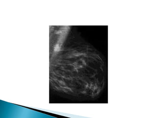 Spiculate breast mass | PPTX