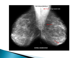 Spiculate breast mass | PPTX