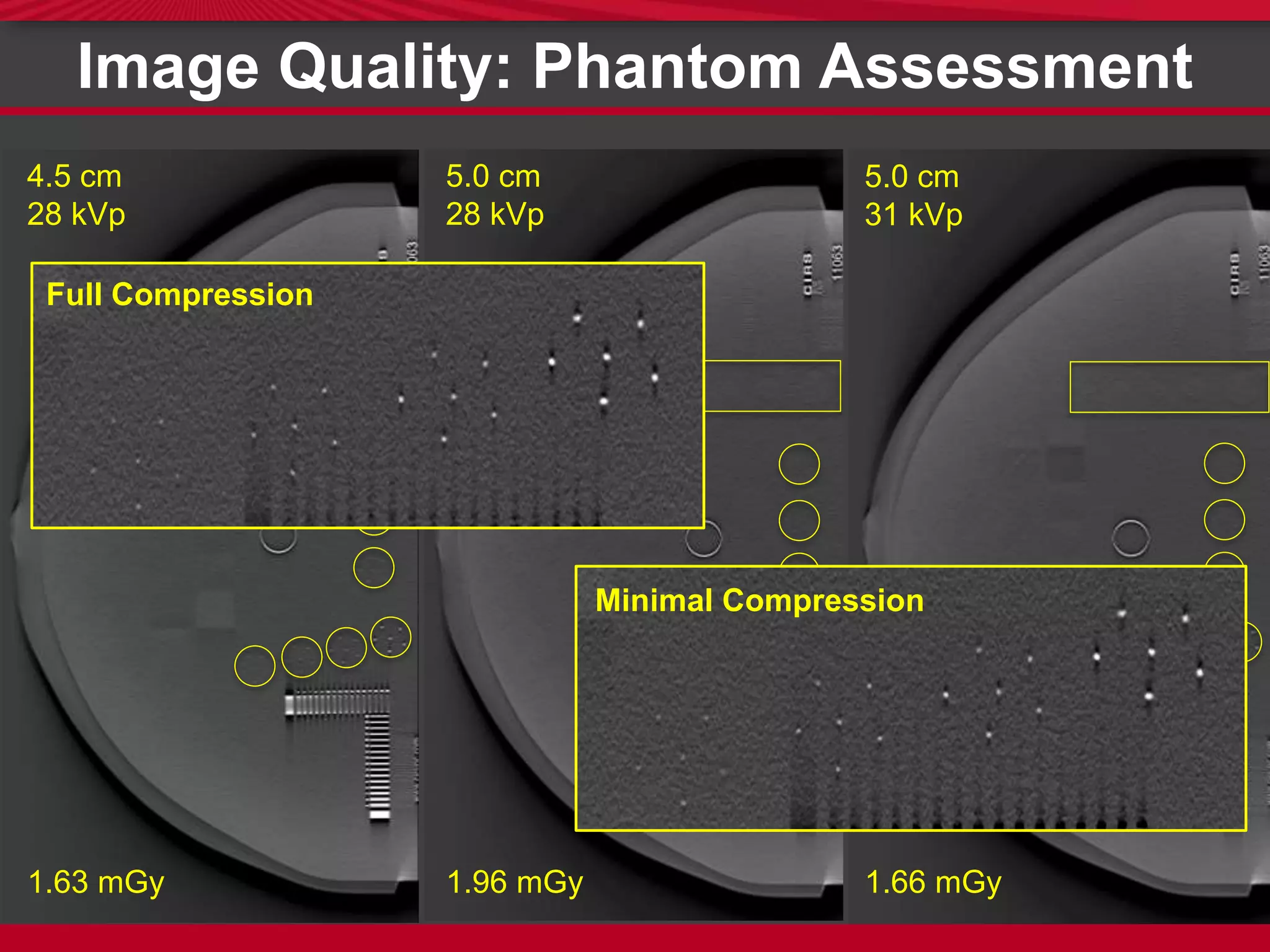 Digital Breast Tomosynthesis with Minimal Compression | PPTX | Medical ...