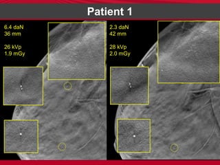 Digital Breast Tomosynthesis with Minimal Compression | PPTX | Medical ...