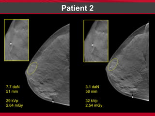Digital Breast Tomosynthesis with Minimal Compression | PPTX | Medical ...