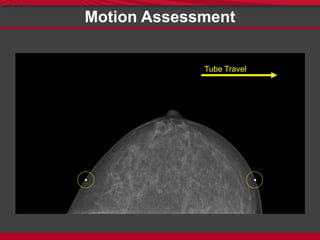 Digital Breast Tomosynthesis with Minimal Compression | PPTX | Medical ...