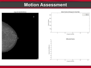 Digital Breast Tomosynthesis with Minimal Compression | PPTX | Medical ...