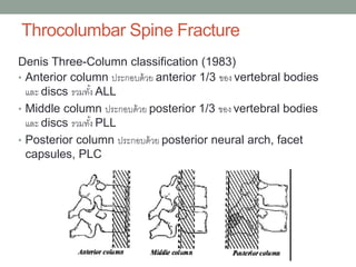Spinal Fx | PPT