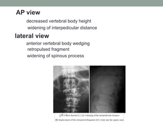 Spinal Fx | PPT