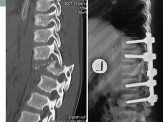 Spinal Fx | PPT
