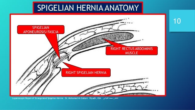 Laparoscopic Repair of Strangulated Spigelian Hernia