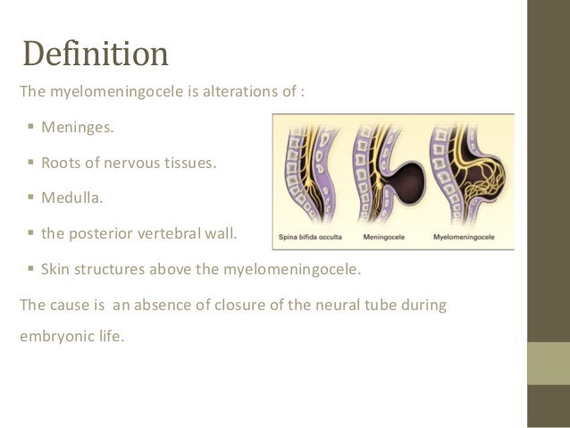 Skin closure of large spina bifida myelomeningoceles