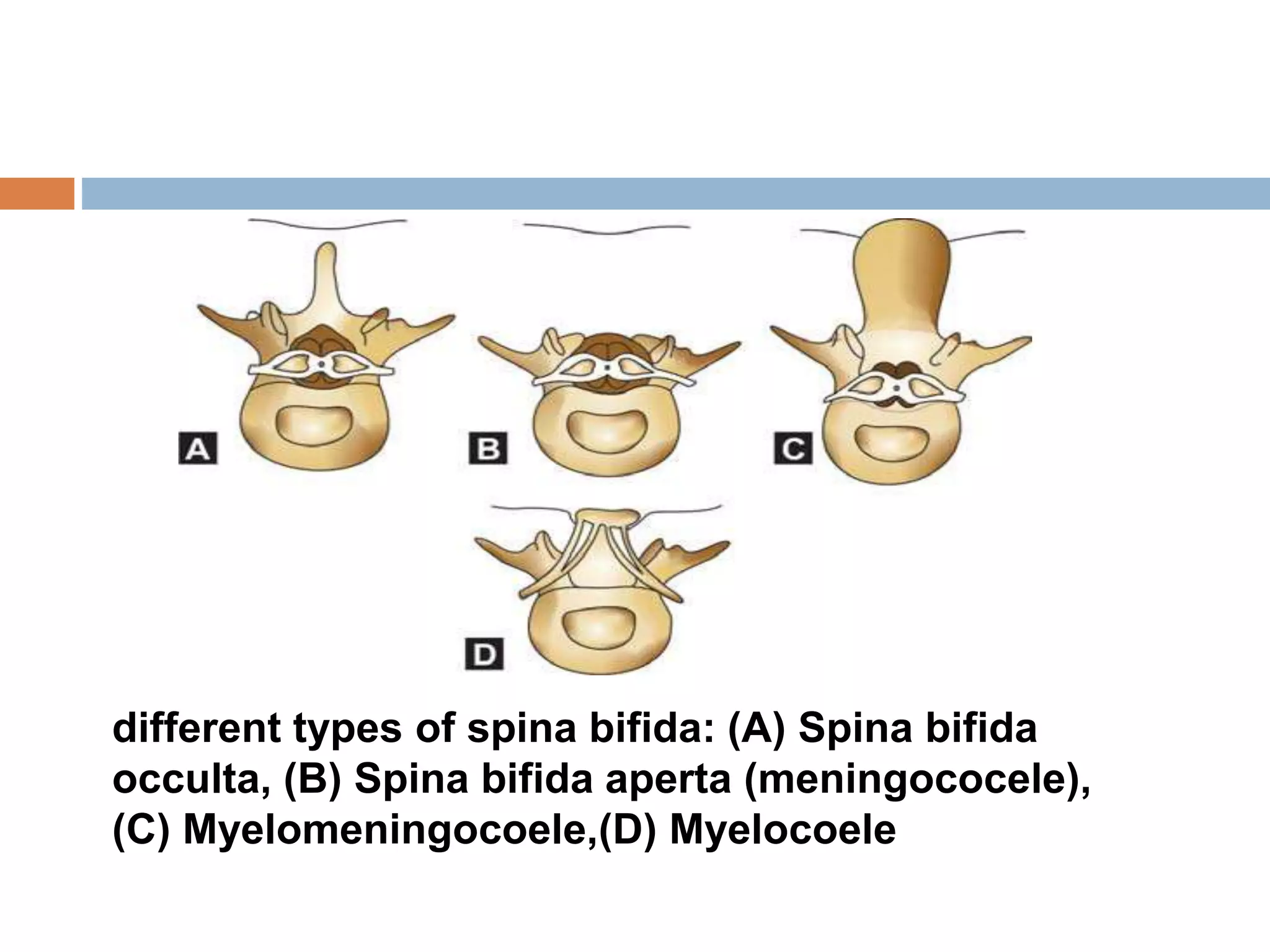 Spina Bifida -1.pptx