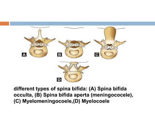 Spina Bifida -1.pptx