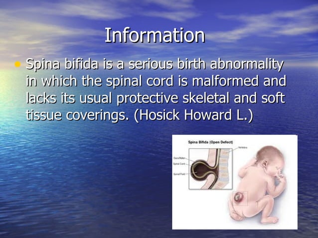 Spina bifida | PPT