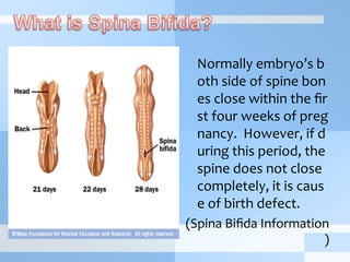 Spina bifida | PPT