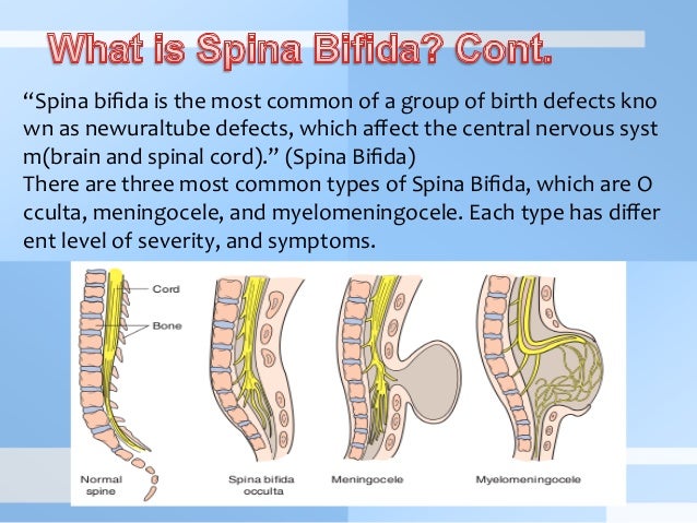 Radiographie Du Spina Bifida