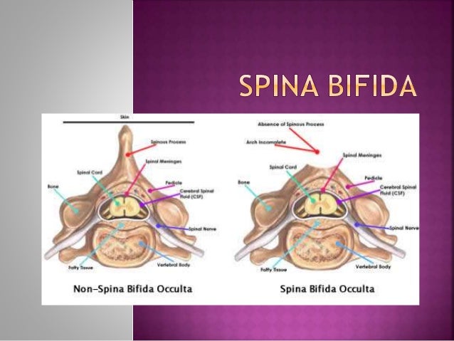 Spina bifida