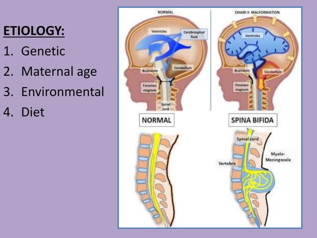 Spina bifida Neurological disorder | PPT