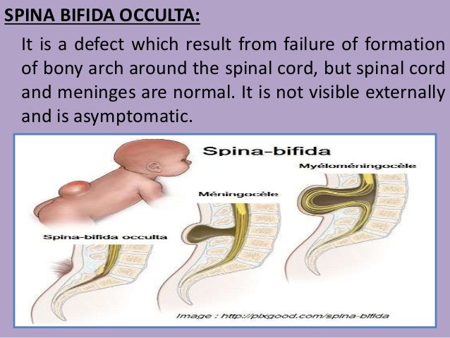Spina bifida Neurological disorder