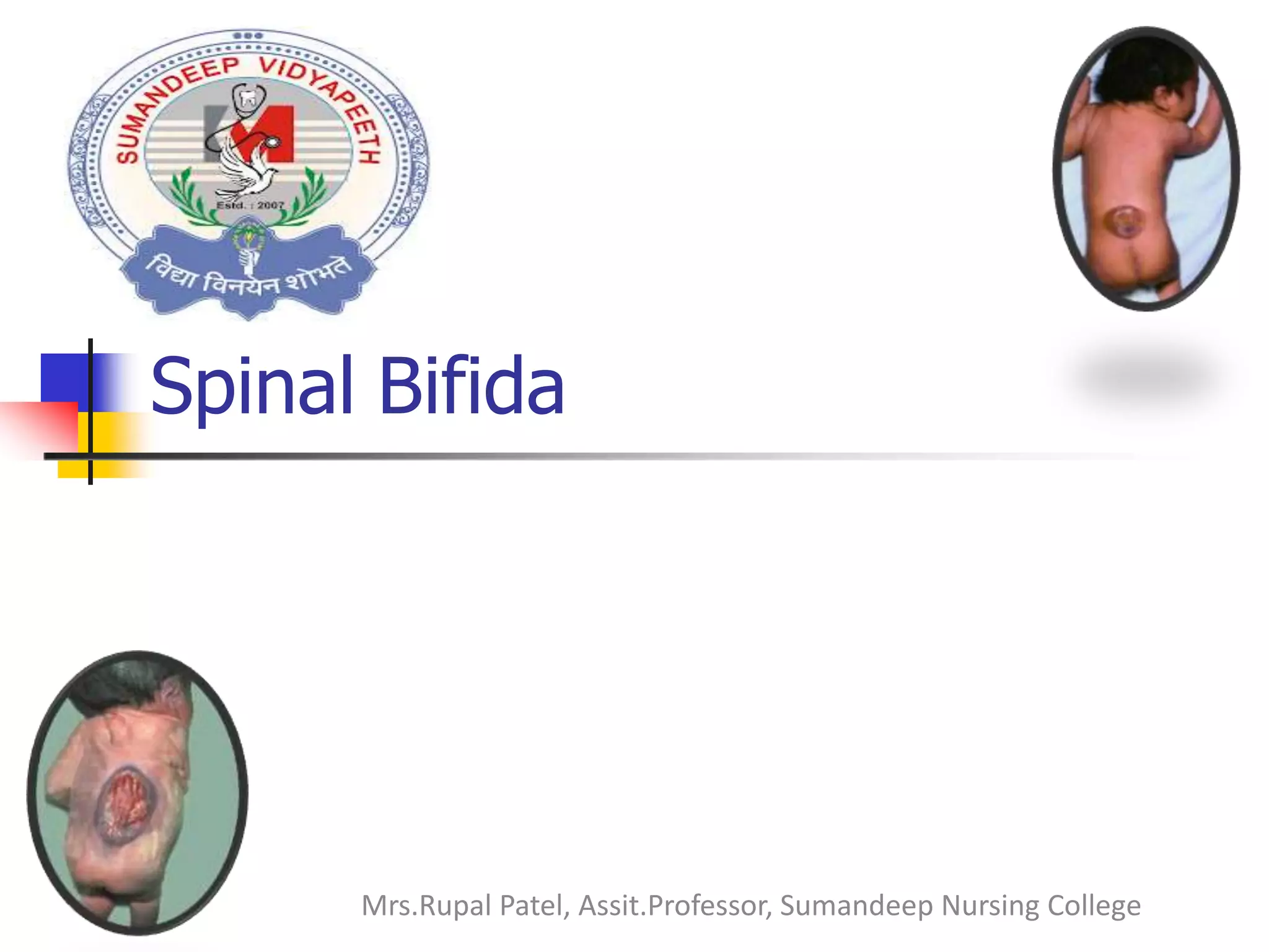 Spina bifida... | PPTX